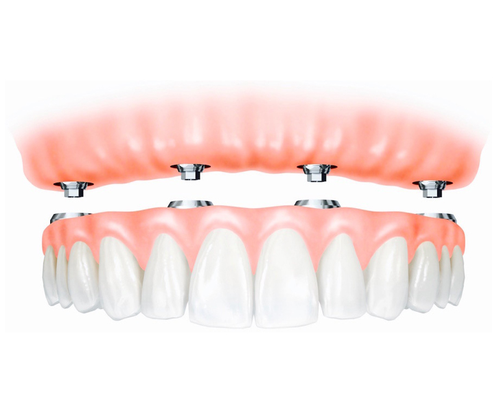 BEST DENTURES IN LUDHIANA | FIX TEETH IN 3 DAYS