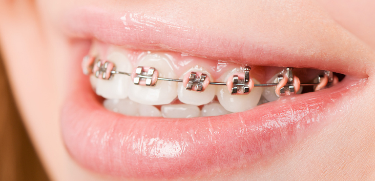 BRACES DENTISTRY IN LUDHIANA | DR. GOYAL'S DENTAL CLINIC